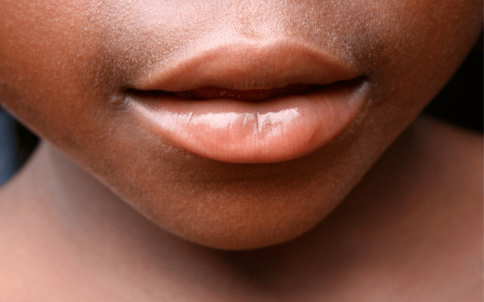 Cold Sore Symptoms in Kids: What Every Parent Should Know