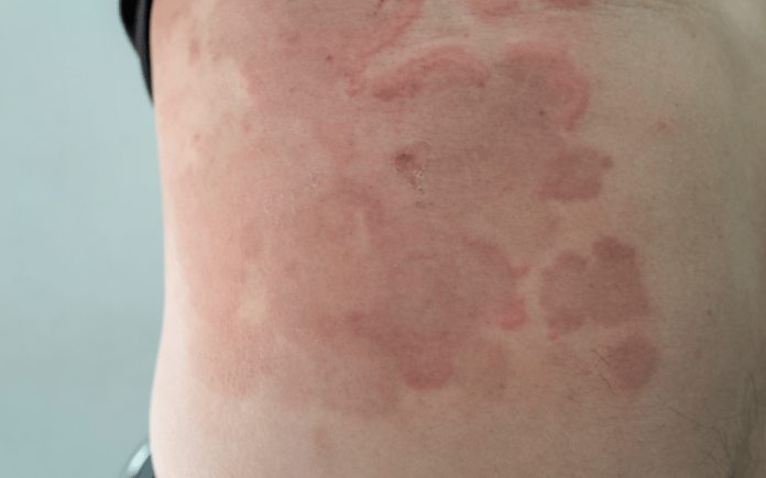 10 Telltale Symptoms of Erythema Multiforme You Need to Know