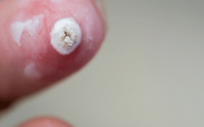 Filiform Warts: What They Are and How to Tackle Them