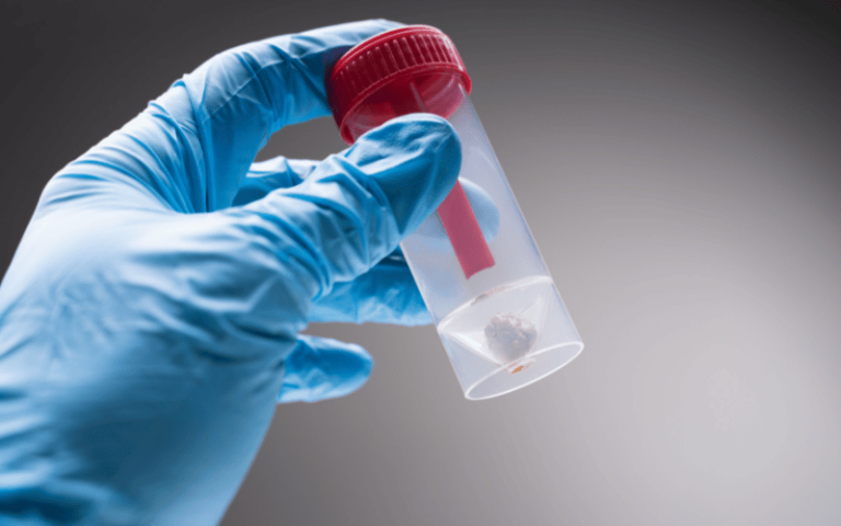 10 Causes of Blood in Stool (Hematochezia): What You Need to Know