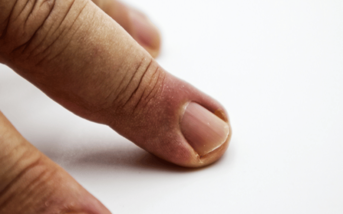 10 Telltale Symptoms of Herpetic Whitlow: Everything You Need to Know