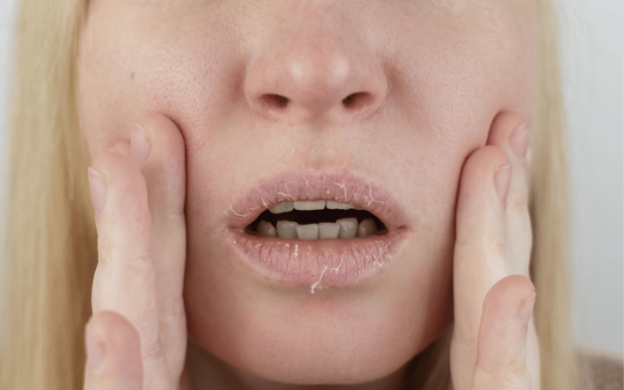 10 Signs Your Mouth Might be Suffering from Angular Cheilitis - Page 2 ...