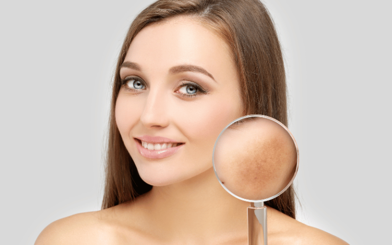 Unlocking the Secrets of Fordyce Spots: A Deep Dive into the Mysteries ...