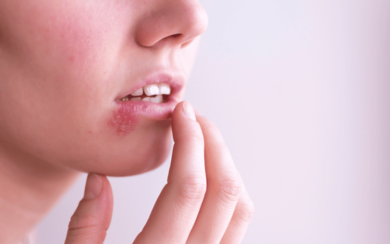 Understanding Shingles: A Closer Look at the Virulent Outbreaks ...