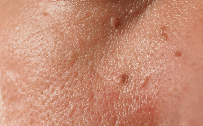 10 Telltale Symptoms of Verruca Plana (Flat Warts) - Page 4 of 11