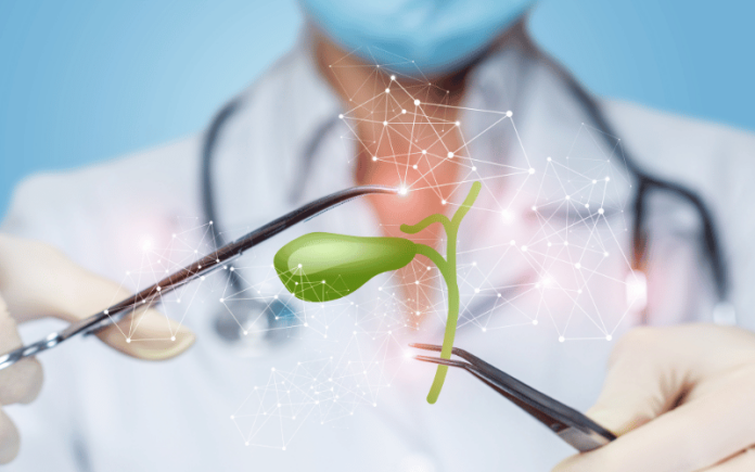 Navigating the Complexity of Mirizzi’s Syndrome: Identifying Top 10 ...