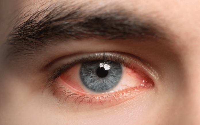 10 Telltale Symptoms of Mucous Membrane Pemphigoid (MMP): What You Need ...