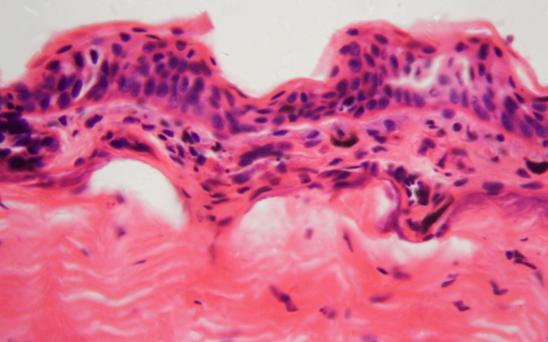 10 Alarming Symptoms of Spindle Cell Carcinoma You Shouldn't Ignore ...