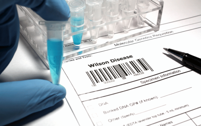 The Top 10 Indicators of Wilson's Disease: What You Need to Know