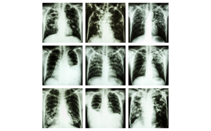 Bronchiectasis: Prognosis and Perspectives