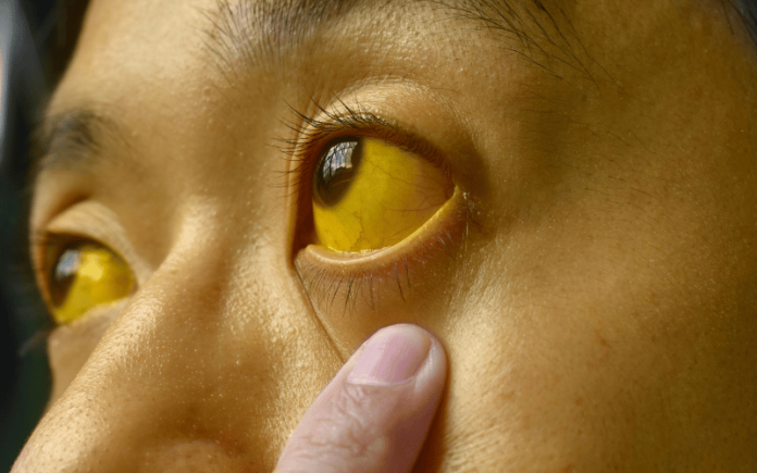 Cholestasis and You: Identifying the Top 10 Warning Signs