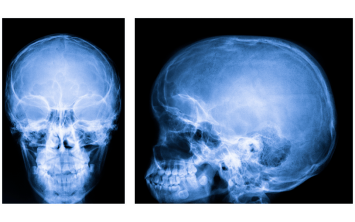 Unveiling Apert Syndrome: 10 Key Insights and Facts - Page 2 of 11