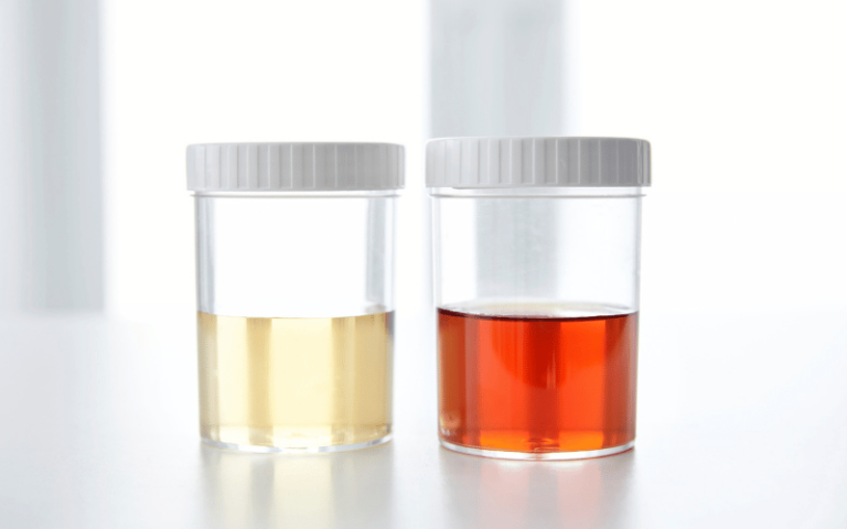 Gallstones: The Signs and Symptoms to Know - Page 6 of 11