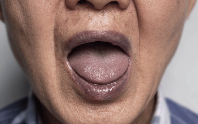 Understanding Methemoglobinemia: Key Symptoms and Insights