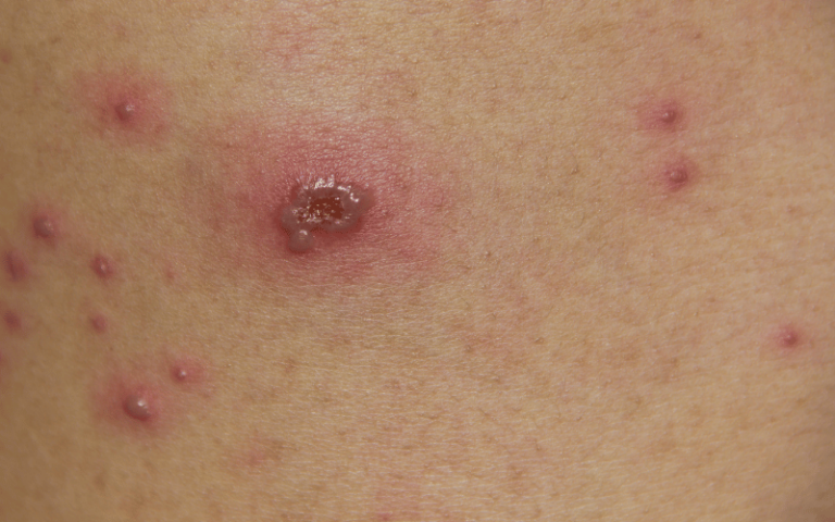 Understanding Chickenpox in Adults: A Comprehensive Overview - Page 2 of 11